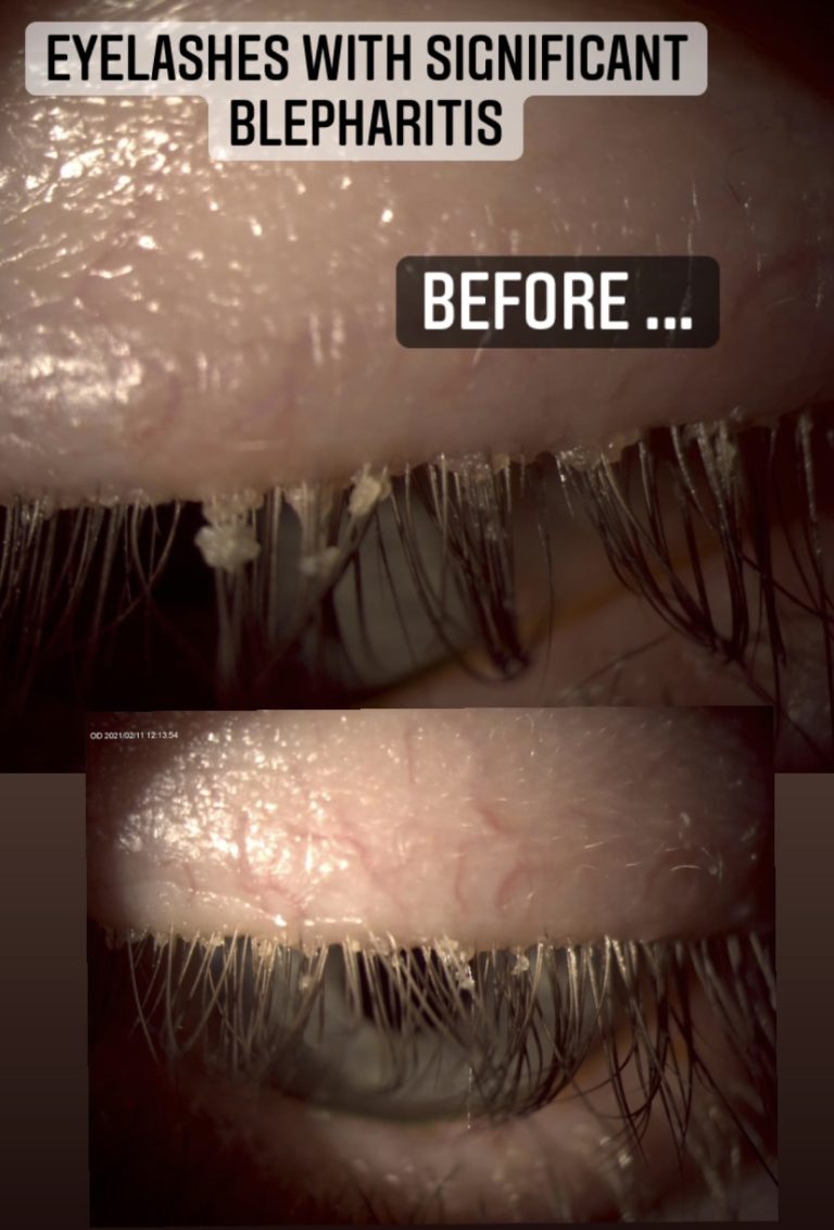 Blepharitis Management in Vancouver | Vancouver Eye Doctor