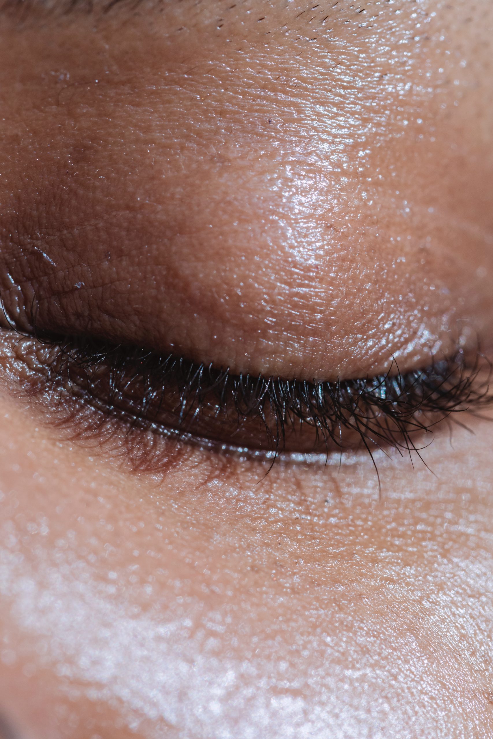 Meibomian Gland Expression in Vancouver | Vancouver Eye Doctor